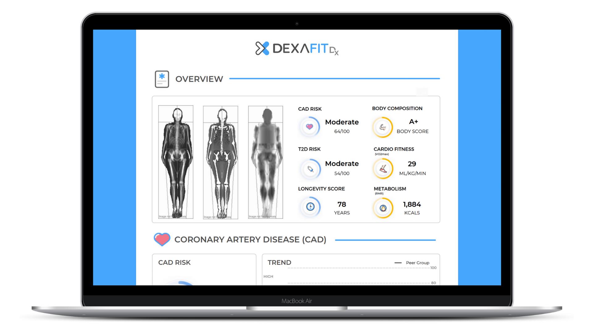 DexaFit DX AI Upgrade - Body Science Coaching & DexaFit Seattle